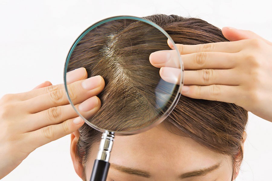 Improving blood flow in scalp helps hair growth | The Financial Express