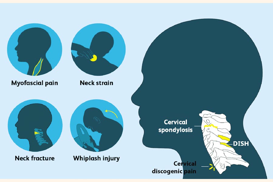 Bad lifestyle choices cause neck pain | The Financial Express