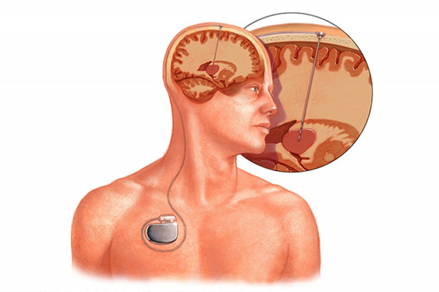 China-made brain pacemaker brings hope to Parkinson's patients | The ...